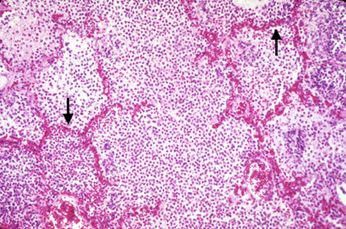 Pneumonia Lung Slide