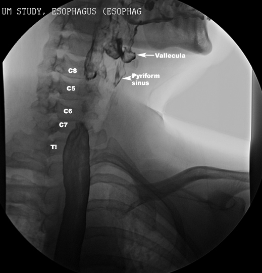 Valleculae And Pyriform Sinuses