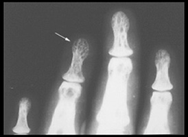 Image of Sarcoidosis - Extrathoracic