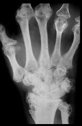 Image of Sarcoidosis - Extrathoracic