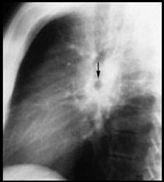 Image of Sarcoidosis - LATERAL CHEST RADIOGRAPH