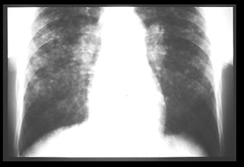 Image of Sarcoidosis - Lung Parenchymal Disease