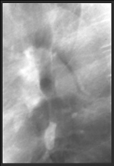 Image of Sarcoidosis - LATERAL CHEST RADIOGRAPH