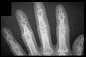 Image of Sarcoidosis - Extrathoracic