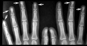 Image of Sarcoidosis - Extrathoracic
