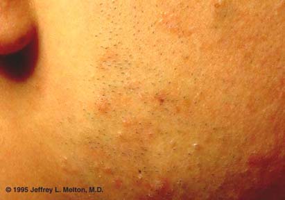 Flat warts of the face