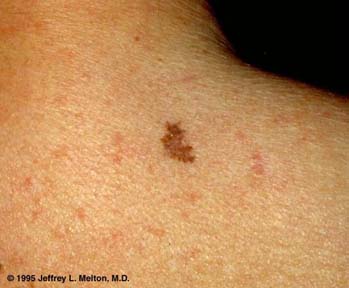 Melanoma On Back