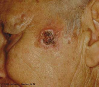 Squamous Cell Carcinoma of the Cheek