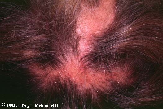 Lichen planus pilaris