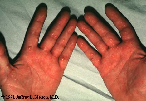 Xanthomas (Eruptive)