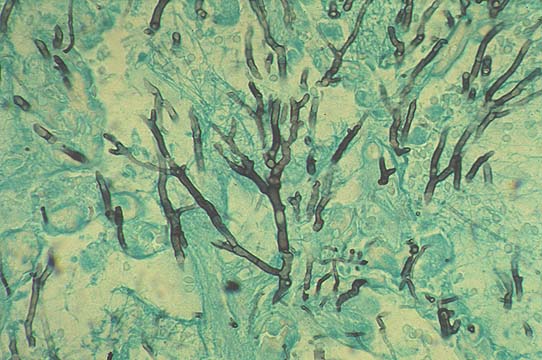 Parasitic Infestations