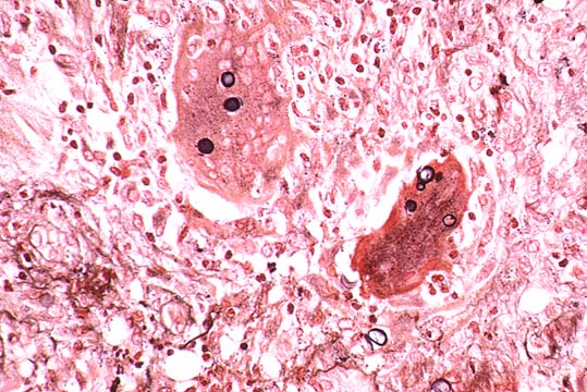 Parasitic Infestations