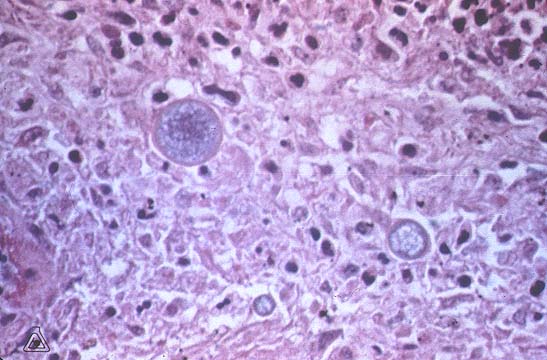 Parasitic Infestations