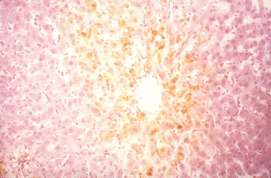 Cholestasis - Histopathology