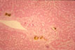 Cholestasis - Histopathology