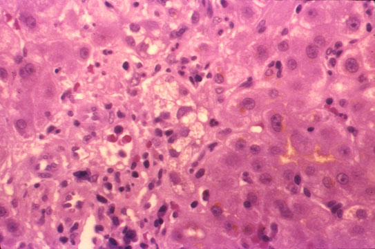 Cholestasis - Histopathology