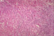 Reaction to Injury - Inflammation