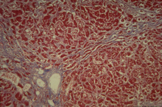 Liver Fibrosis