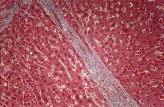Liver Cirrhosis