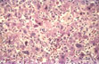 Viral Hepatitis A
