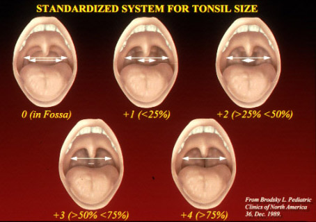 Tonsil Grading Chart