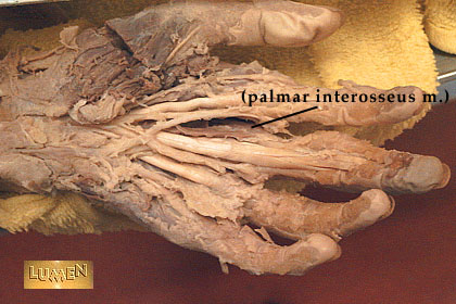 Hand 3 Dissection