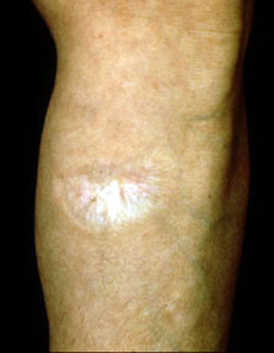 Lesions: When a lesion is detected describe the type, color ...