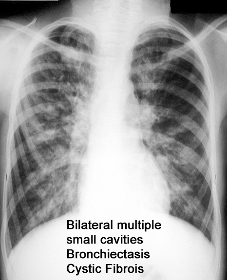 Cavity in Chest x-ray / Radiology