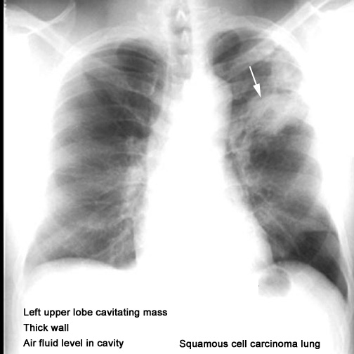 Cavity in Chest x-ray / Radiology