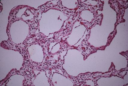 Diffuse alveolar Diffuse interstitial Vascular Mixed