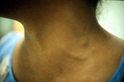 Collateral Distention