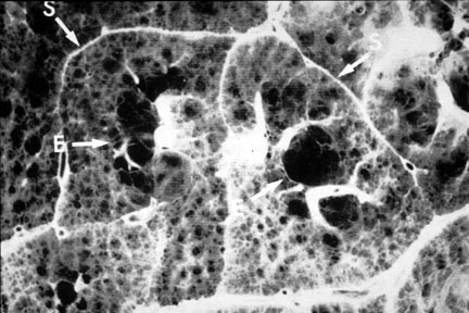 Centrilobular emphysema/Ba in arteries E-Emphysema S-septa.