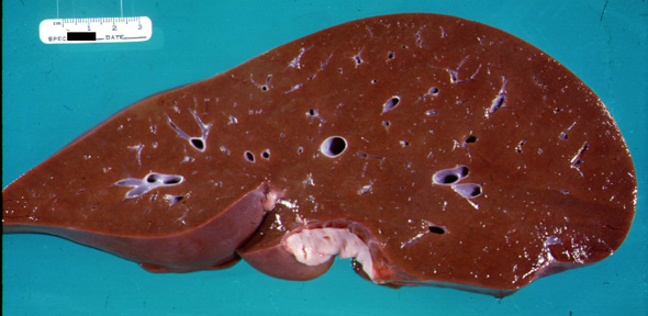 Brown Induration Of Lungs