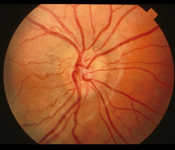 Funduscopic Examination