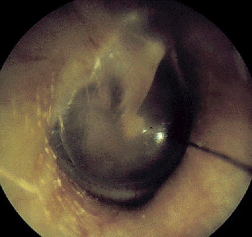 Otoscopic Examination