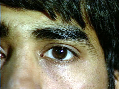 External Examination of Eyes