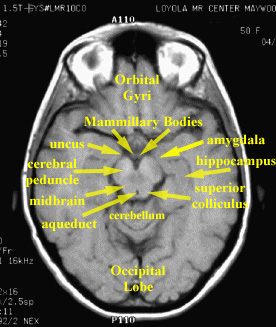 Mammillary Bodies Mri