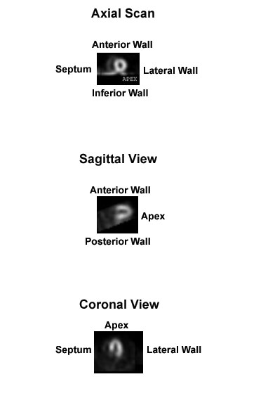 Nuclear medicine Myoview