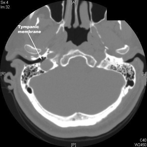 locate tympanic membrane