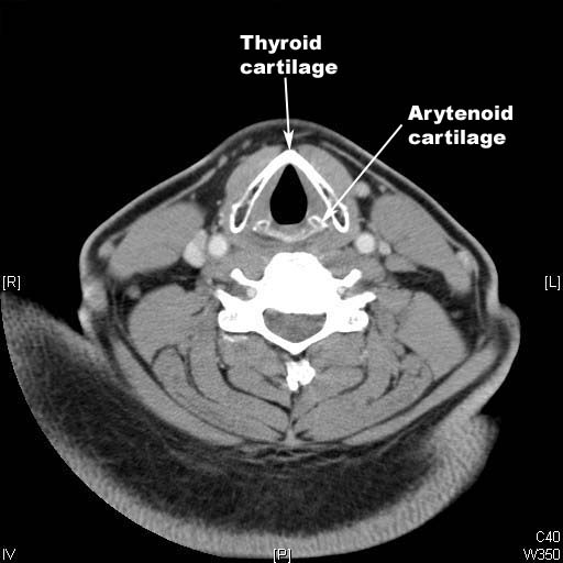 identify thyroid cartilage and artenoid