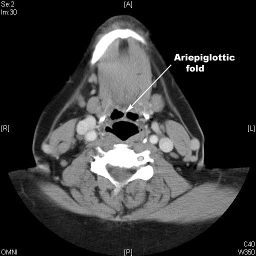 identify aryepiglottic fold