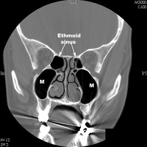 locate ethmoid sinus