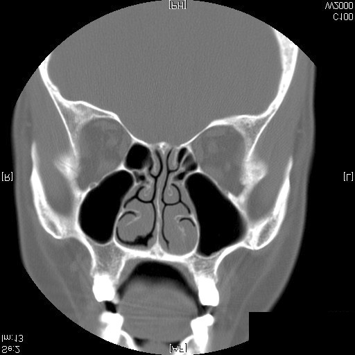 Identify Nasal Turbinates