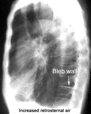 Lateral chest is best to evaluate flattening of diaphragm, AP diameter ...