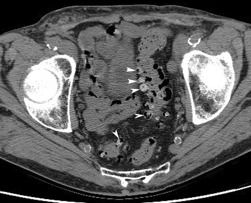 Diverticulosis