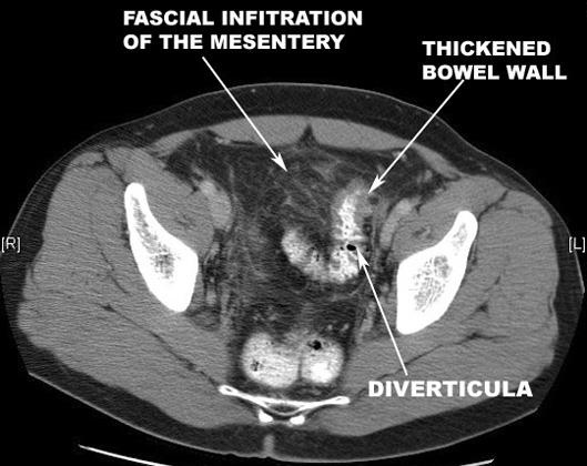 Diverticulosis