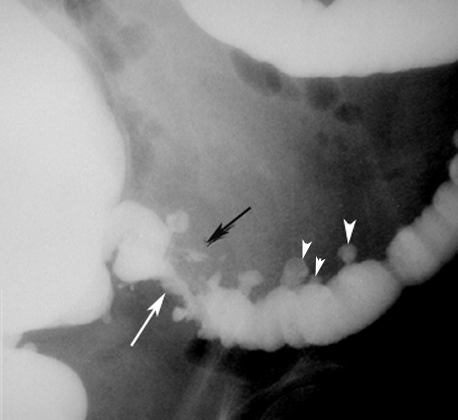 Diverticulosis / Diverticulitis
