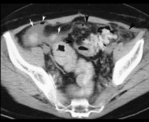 Diverticulosis / Diverticulitis