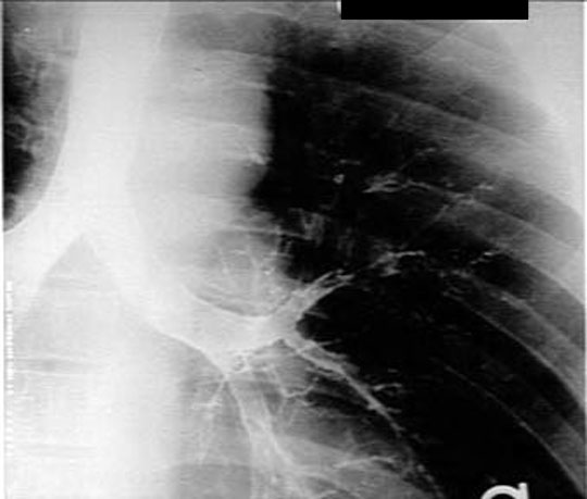 Locate portions of Aorta