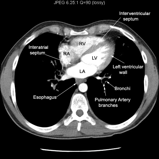 Identify the location of right atrium